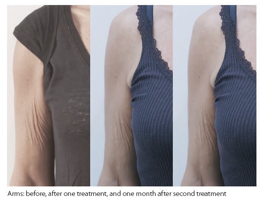 Profhilo Body Protocols - Wigmore Medical