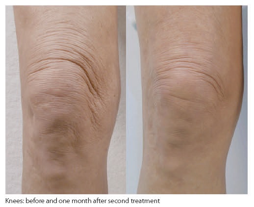 Profhilo Body Protocols - Wigmore Medical