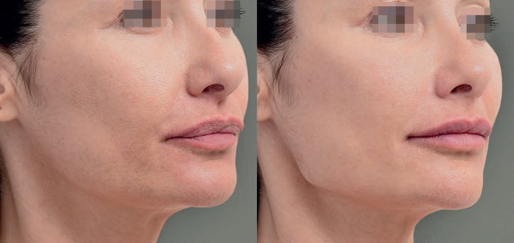 The Global Approach To Facial Volume Restoration - Wigmore Medical